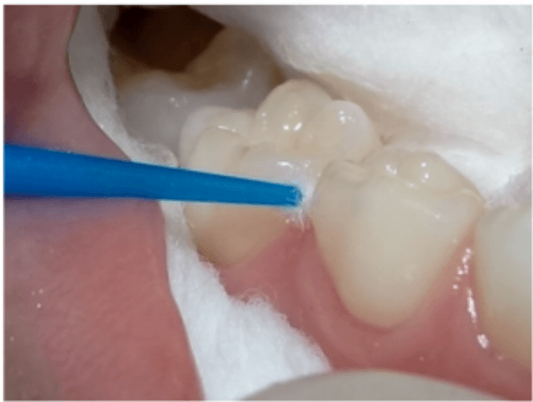 Silver Diamine Fluoride – Golden Kids Dental & Orthodontics